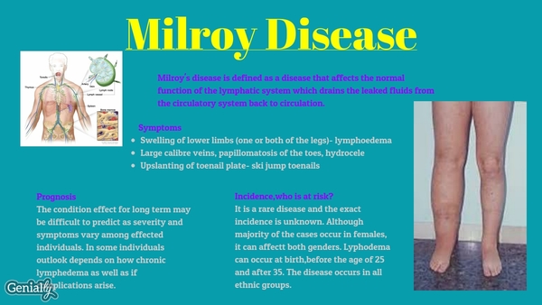 Milroy Disease